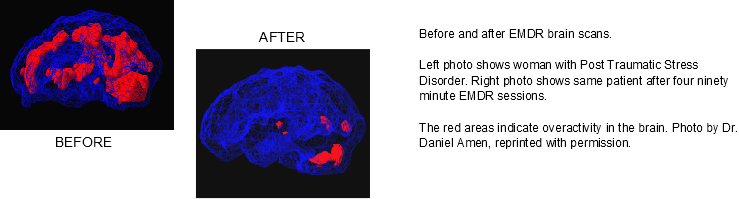 EMDR Therapy – Ron Huxley LMFT